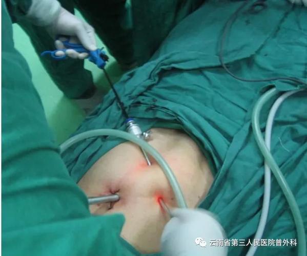 疝气手术全过程视频