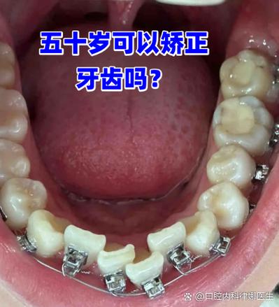 能单独矫正一颗牙吗图标