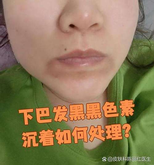 下颚线不明显怎么办