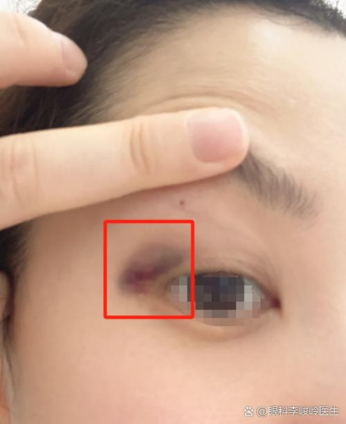 眼睛被打淤青变紫多久能好图标