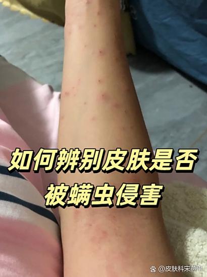 如何用手机看到螨虫截图