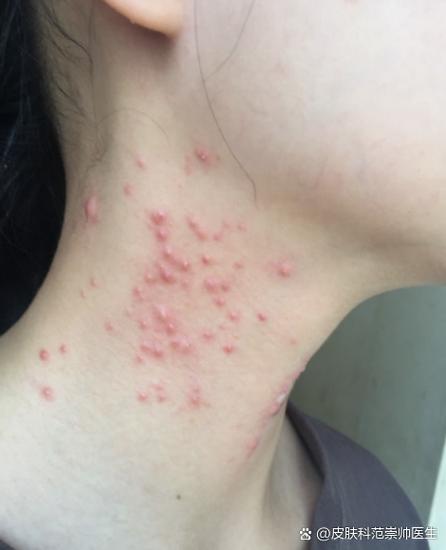 脖子上面长痘痘是什么原因图标