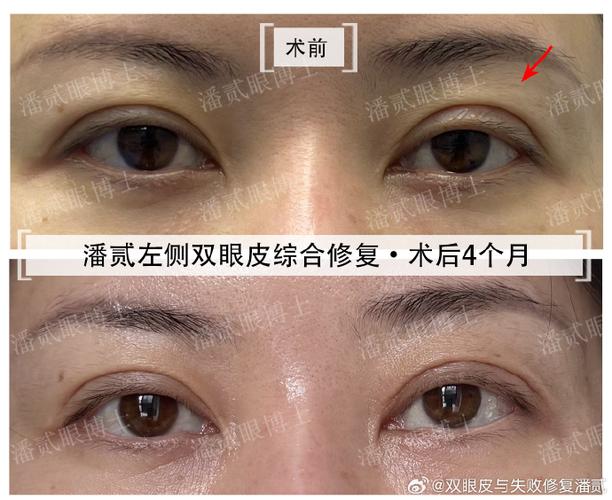 做二次双眼皮修复风险大吗图标