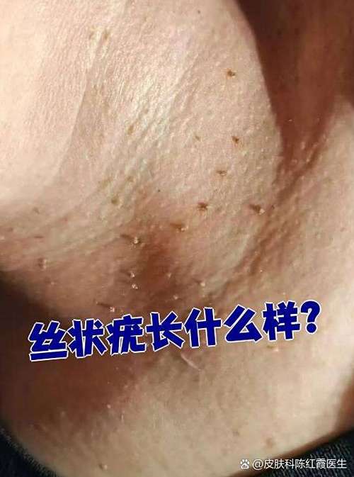 丝状疣属于hpv什么型截图