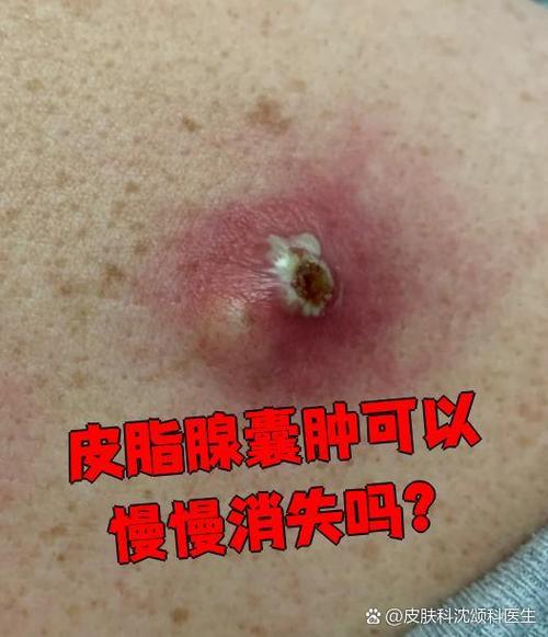 皮脂腺囊肿会自愈吗
