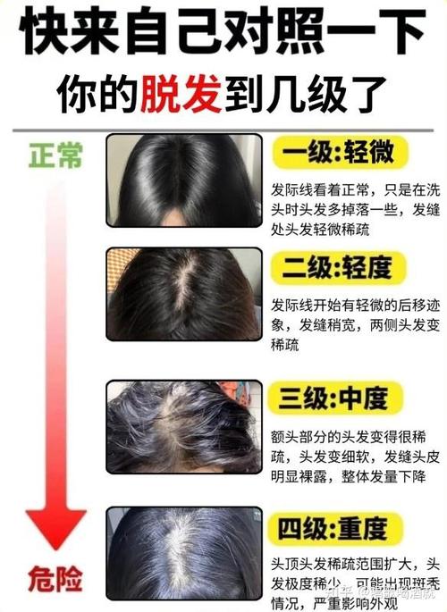 头顶脱发严重怎么办图标