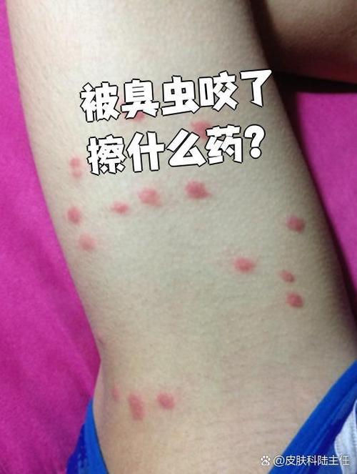 臭虫什么药可以彻底根除图标