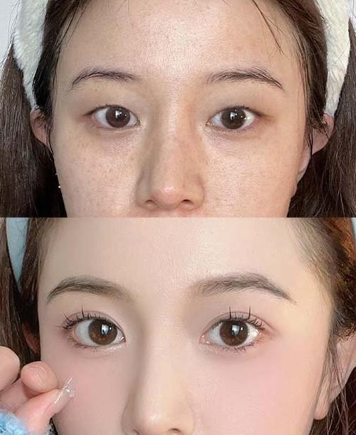 双眼皮变单眼皮怎么恢复回来图标