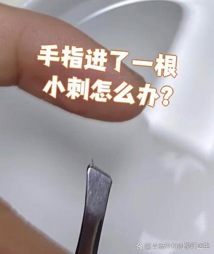 手指扎进刺小妙招