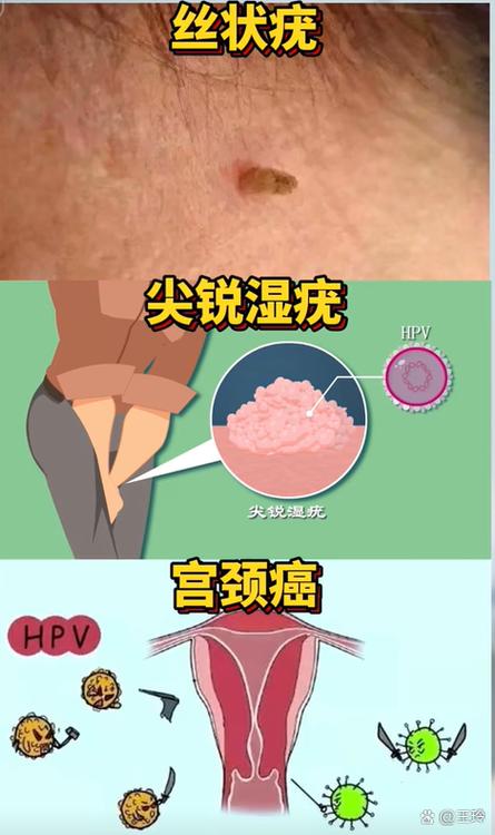 人乳瘤病毒感染是什么病图标