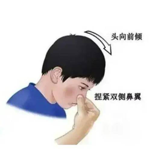 流鼻血是怎么回事缩略图