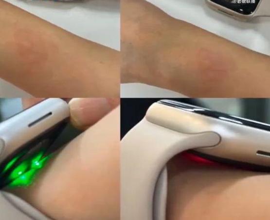 applewatch手腕刺痛