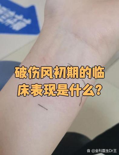 破伤风的临床表现图标