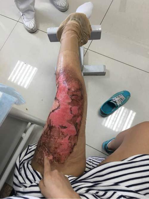 开水烫红了多久能恢复图标