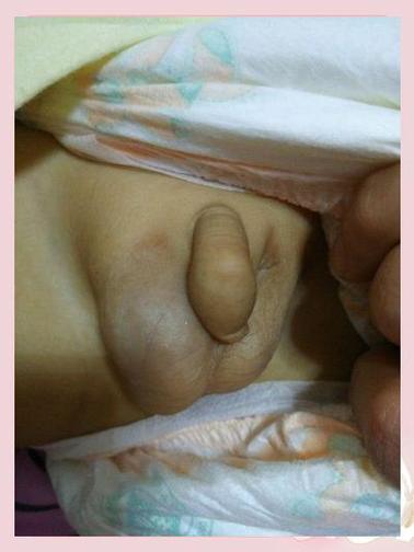 男性睾丸一大一小正常吗缩略图