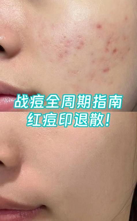 发红的痘印怎么处理截图