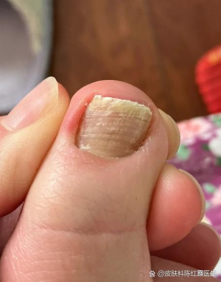 脚拇指出现竖条纹截图
