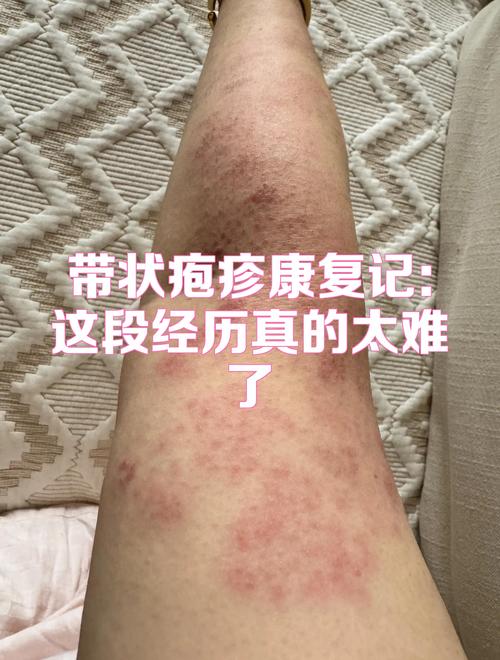 九紫芯辰能量仪治带状疱疹效果好吗