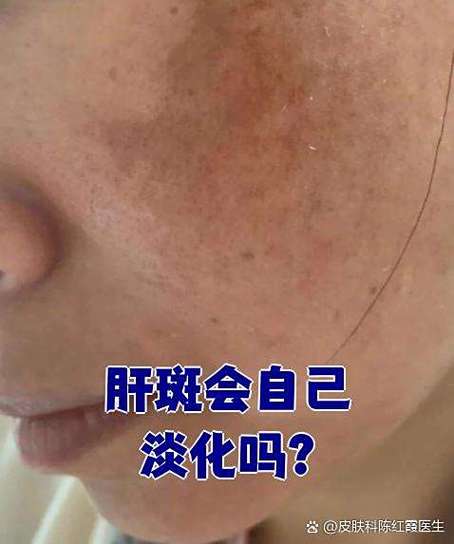 面部七种斑的图片截图