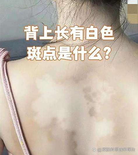 白癣和白斑区别图片图标