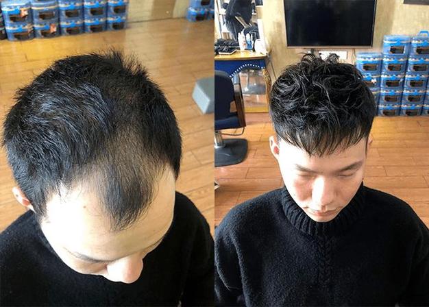 移植头发有什么后遗症截图