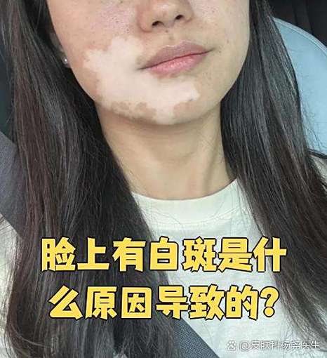 脸上有白斑是什么原因导致的图标