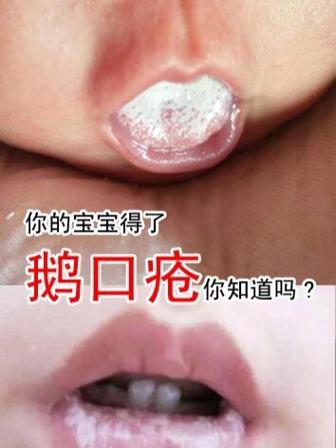 婴儿鹅口疮怎么治好得快