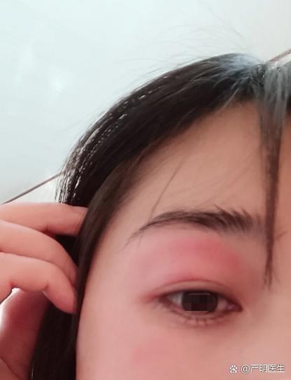 眼睛周围过敏了又红又痒怎么办图标