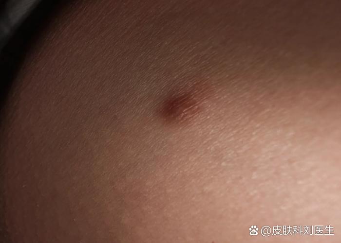 灰白色疙瘩图片图标
