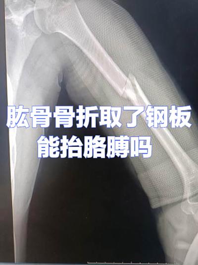 骨折好了钢板可以不取吗图标