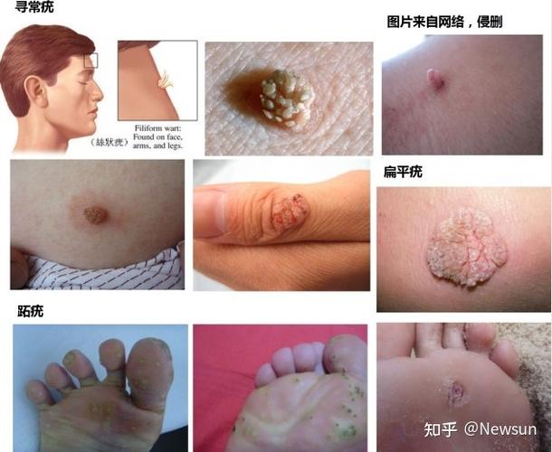 hpv是什么病毒截图