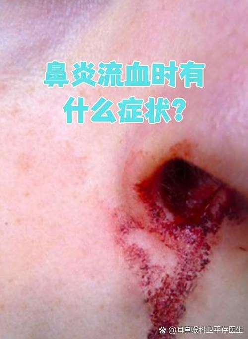 鼻子太干燥流鼻血图标