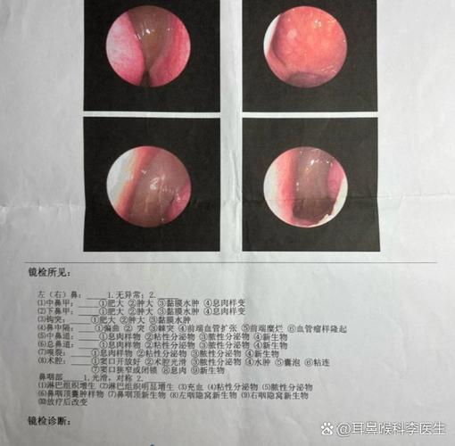 息肉是什么原因造成的图标