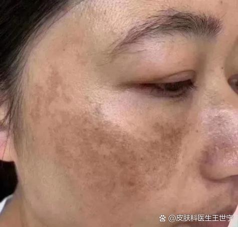 男人脸上黑色素沉淀和斑怎么祛除截图