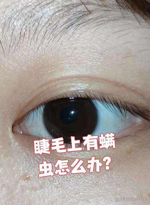 睫毛螨虫什么原因引起的图标