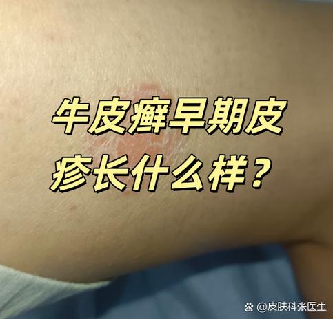 牛皮癣早期图片图标