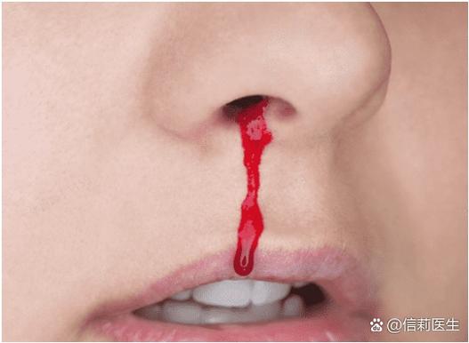 做跳跃训练的时候流鼻血是怎么回事截图