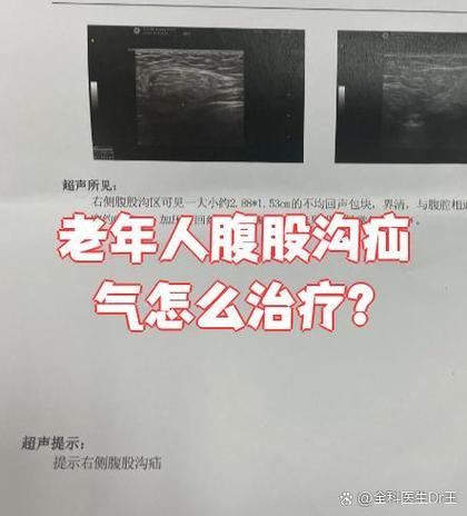60多岁得了疝气怎么办