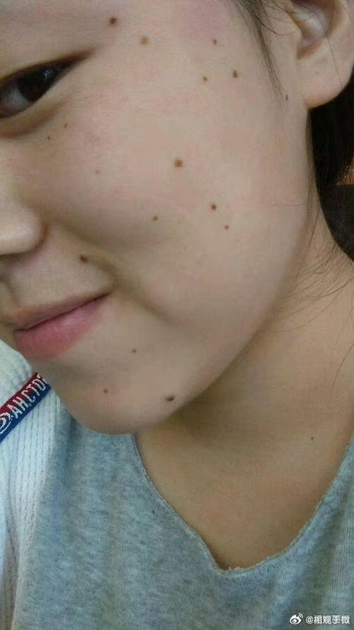 脸上棕色的痣图标