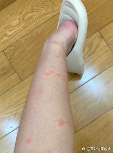 怎么判断被床虱咬了