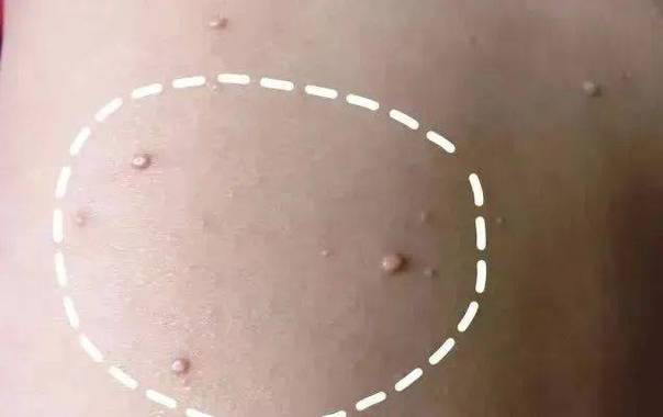 女性私密长痘痘.什么情况截图