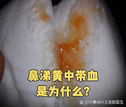 流黄鼻涕和鼻血怎么回事图标