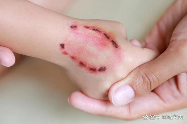 被蚰蜒咬了怎么办图标