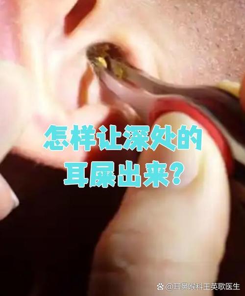 耳塞会把耳屎推进去吗截图