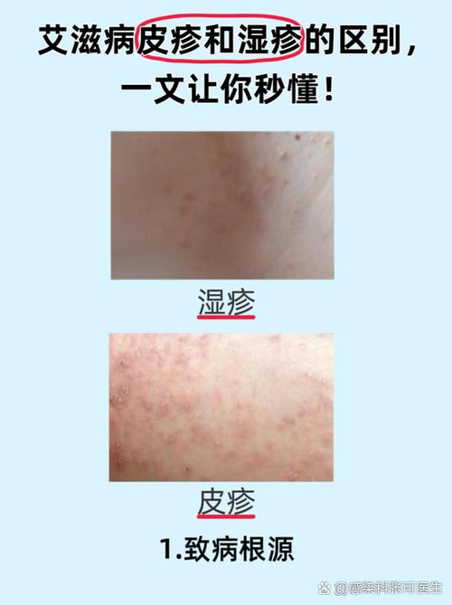 红疹和湿疹图片对照图标