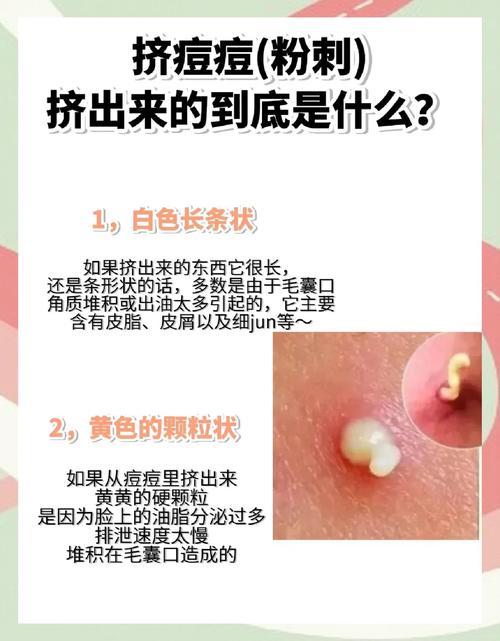 白色的痘痘能挤吗