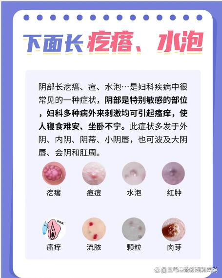女私密部位长痘痘怎么办图标