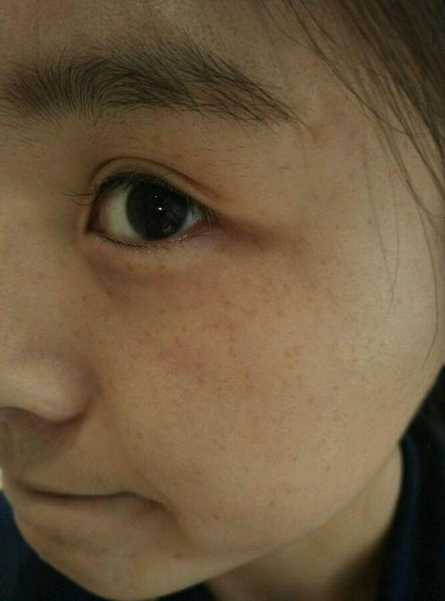 脸上好多小棕色的点图标