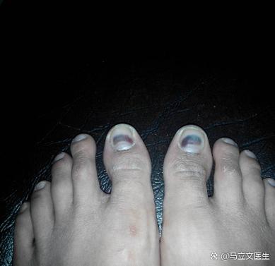 流鼻血黑色的怎么回事图标