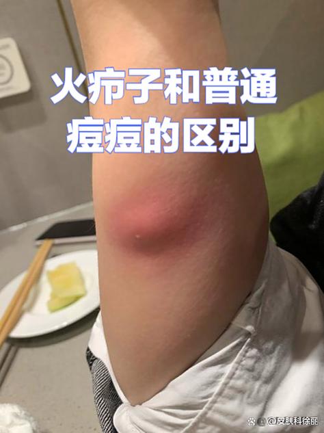 疖肿是热毒吗图标